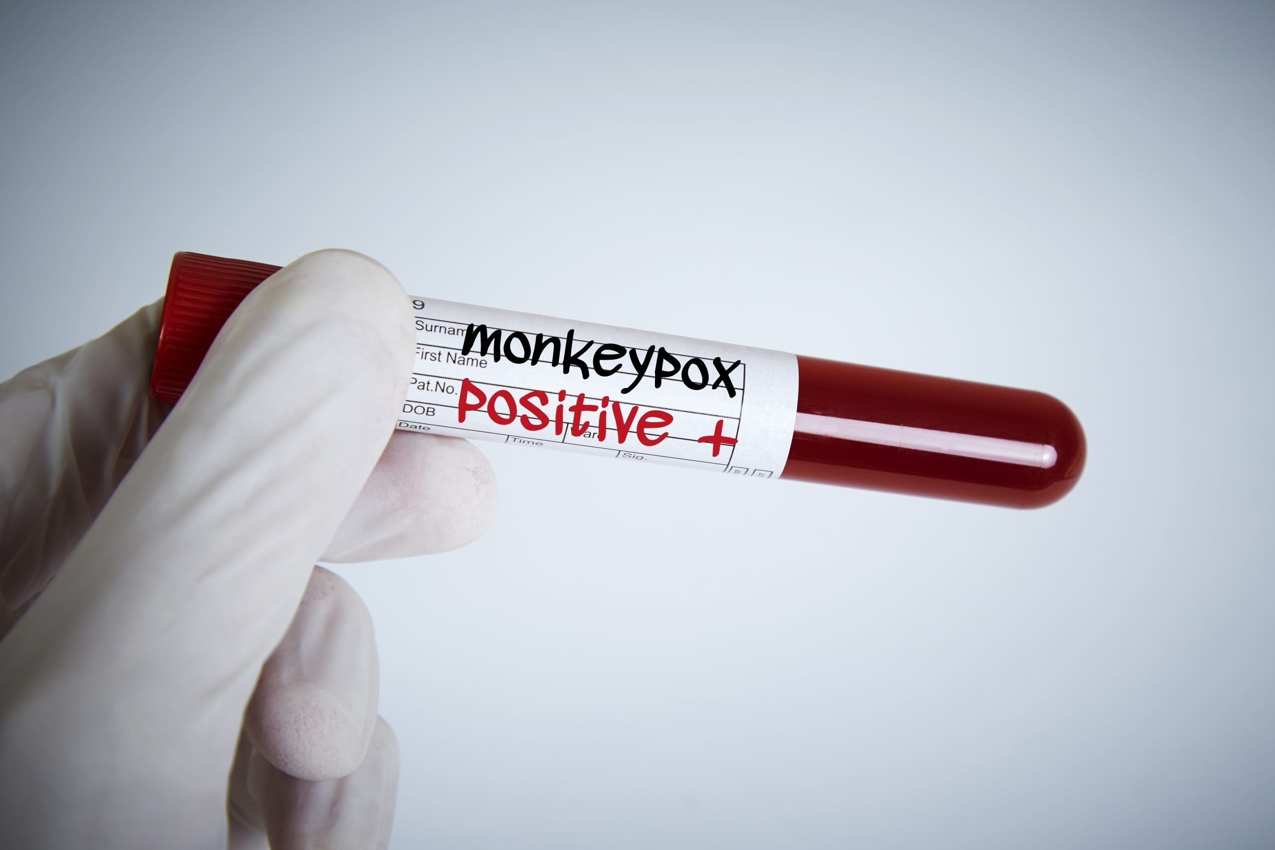 Monkeypox infection may cause serious heart issues – Study - EasternEye
