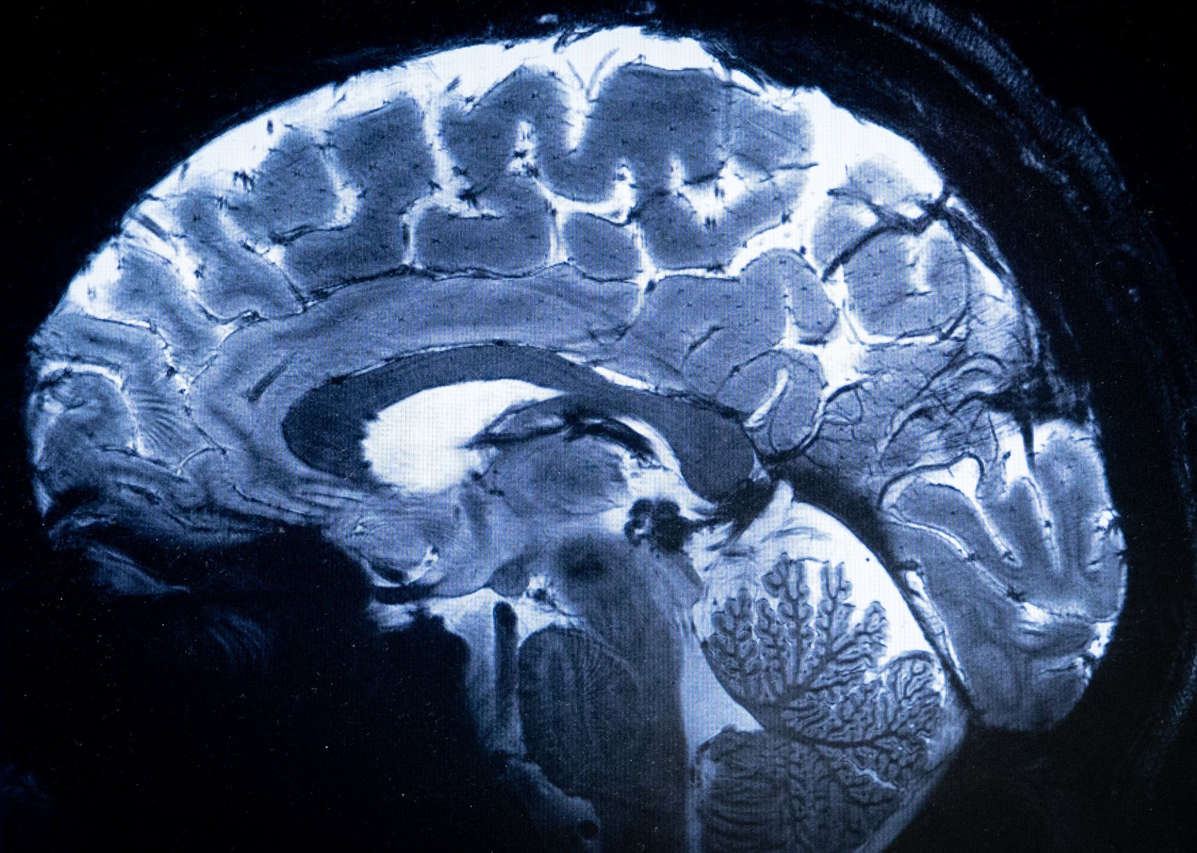 Climate change likely to impact people with brain conditions, study ...